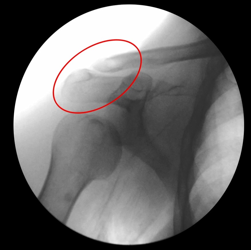 Acromioclavicular Fracture-Dislocation Fixation Technique with ...