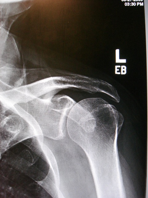 U45 Shoulder Survey - European Society of Sports Traumatology, Knee ...