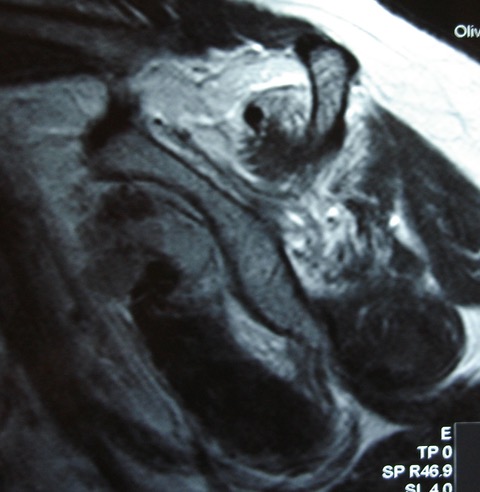 U45 Shoulder Survey - European Society of Sports Traumatology, Knee ...