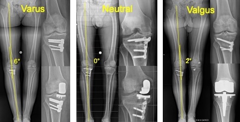 The Unicompartmental Knee Arthroplasty Manual - European Society of ...