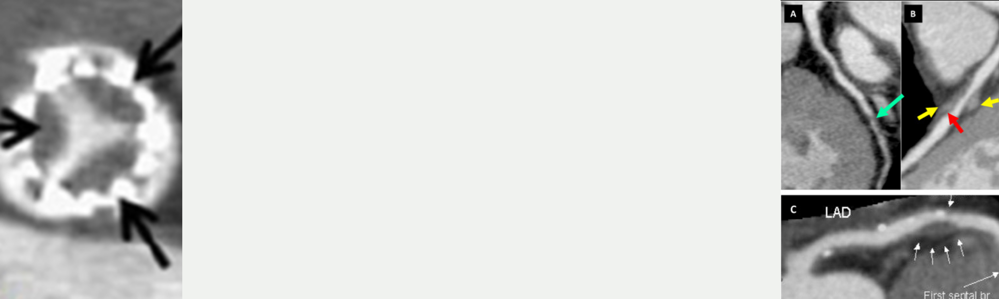 Society of Cardiovascular Computed Tomography