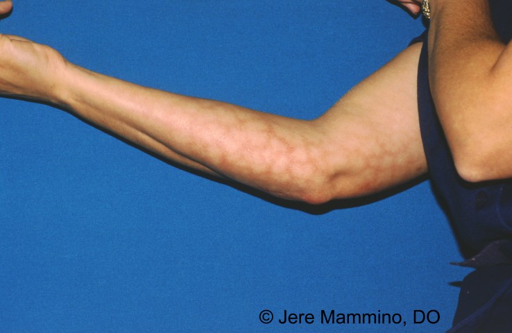 Exercise safety precautions when using heat belts, pads and electric ...